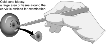 Cervical Cancer Nursing CE Course for APRNs | NursingCE