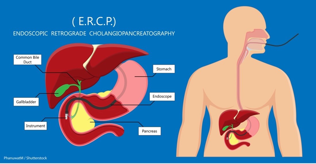 Pancreatic Cancer Nursing CE Course | NursingCE