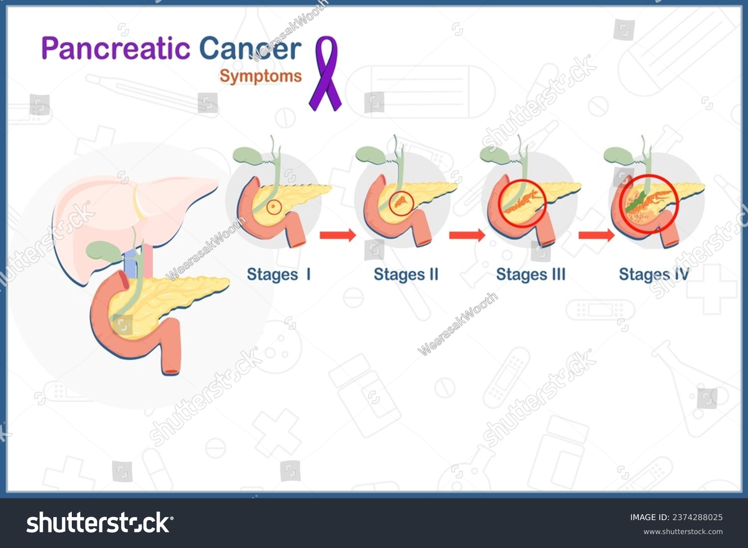 Pancreatic Cancer Nursing CE Course | NursingCE
