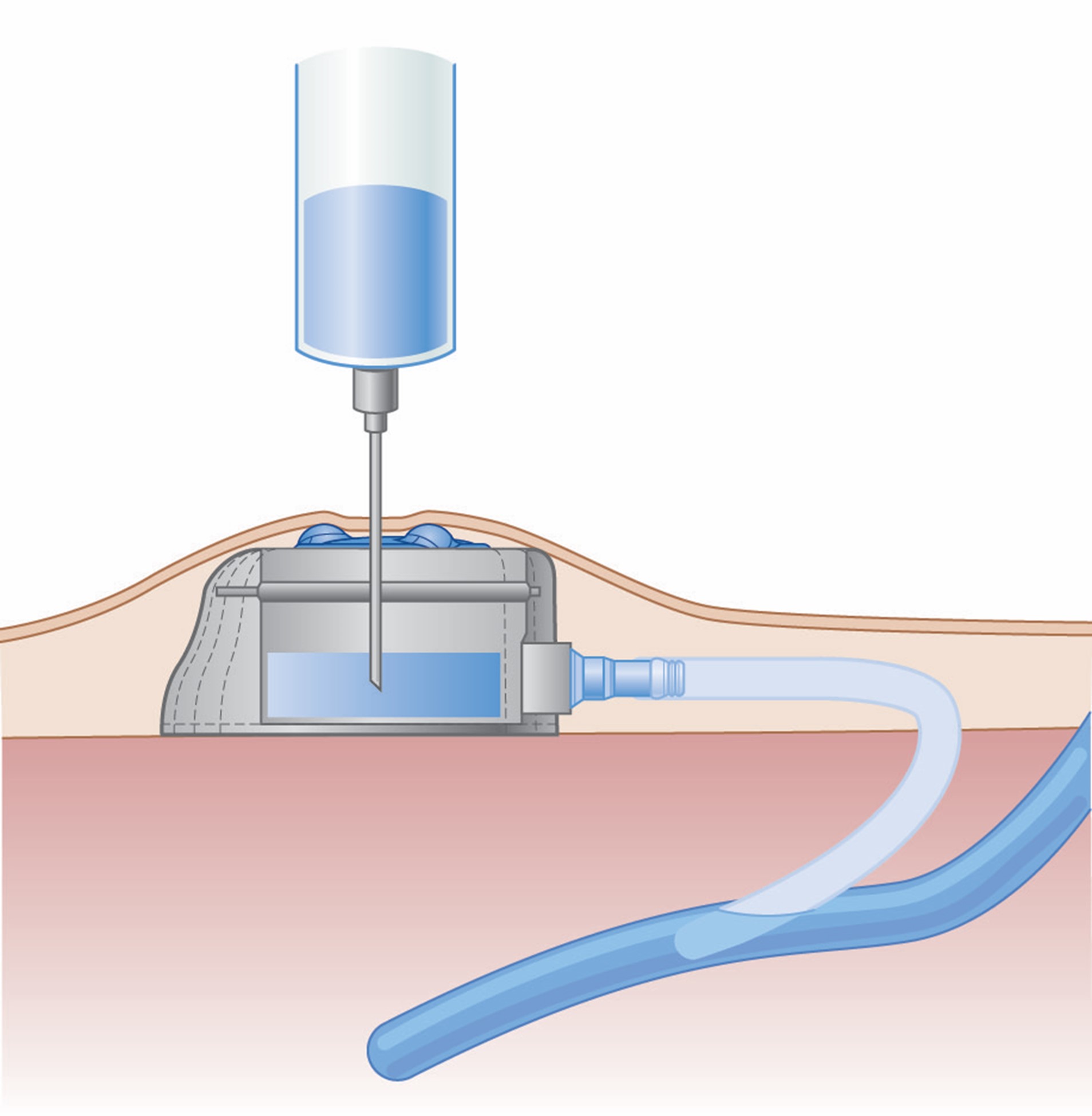 Vascular Access Devices Nursing CE Course | NursingCE