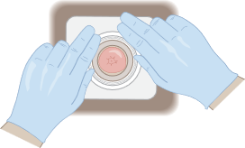 Ostomy Placement and Care Nursing CE Course | NursingCE