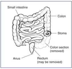 Ostomy Placement and Care Nursing CE Course | NursingCE
