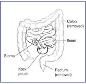 Ostomy Placement and Care Nursing CE Course | NursingCE