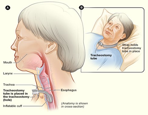 Tracheostomy Placement and Care Nursing CE Course | NursingCE