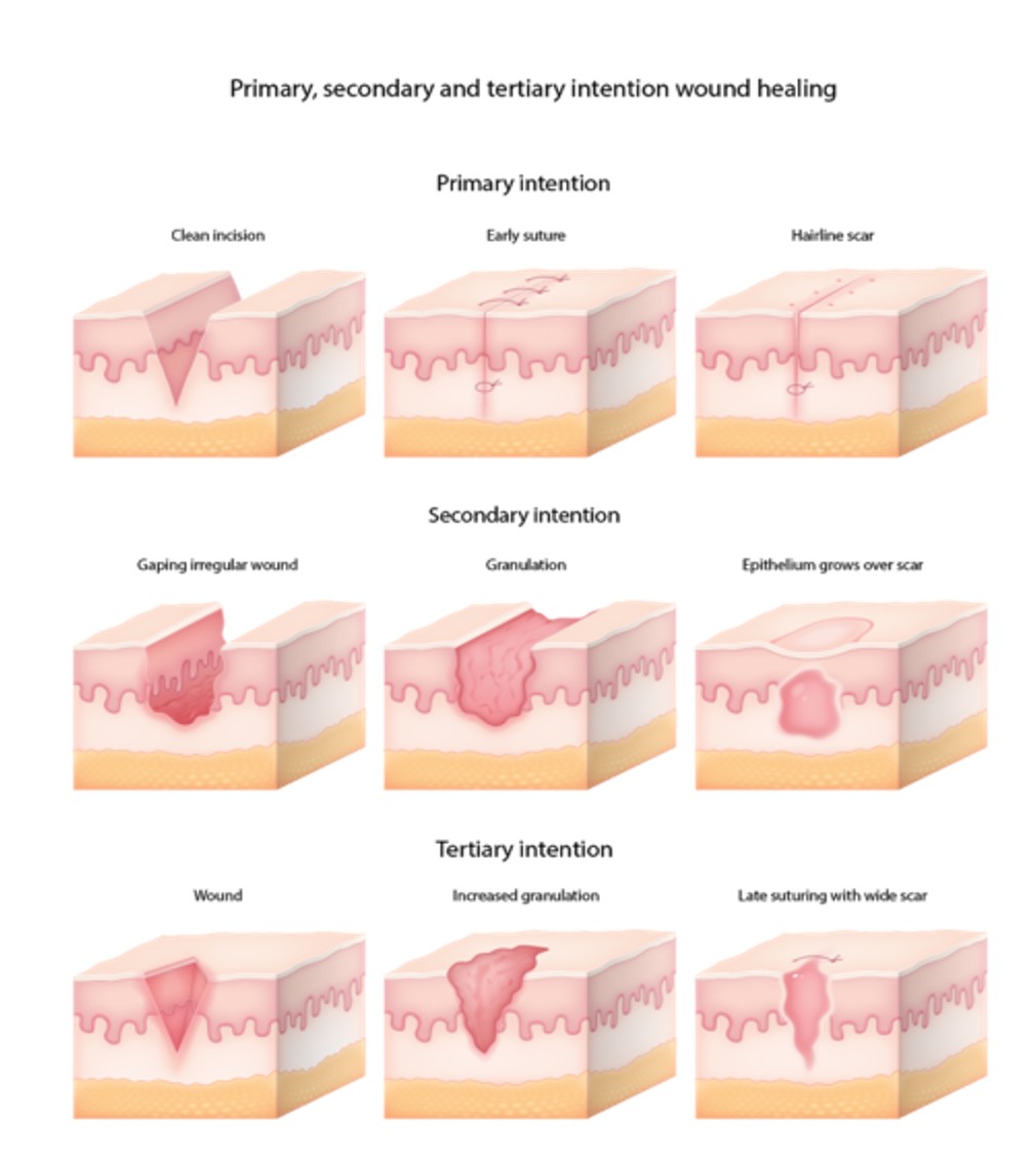 Interdisciplinary Wound Care Nursing CE Course | NursingCE