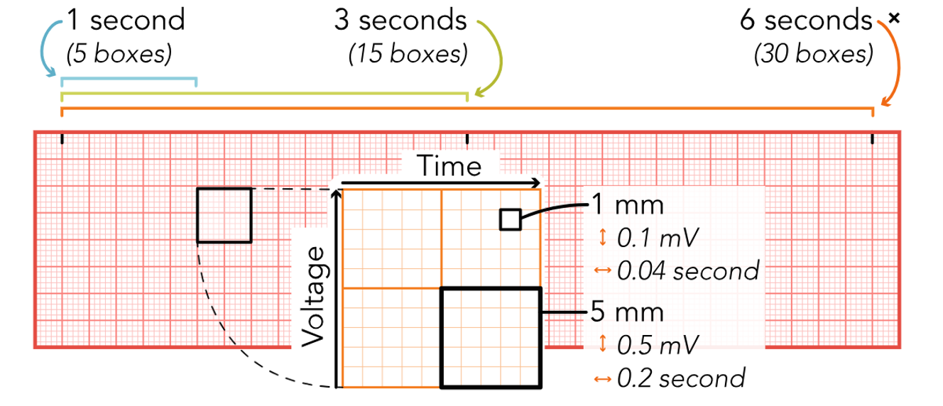 Introduction to Telemetry Monitoring for Arrhythmias Nursing CE Course ...