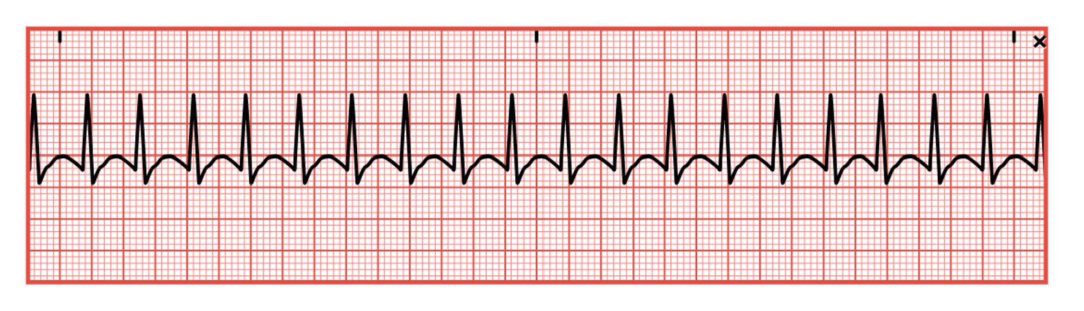 Introduction to Telemetry Monitoring for Arrhythmias Nursing CE Course ...