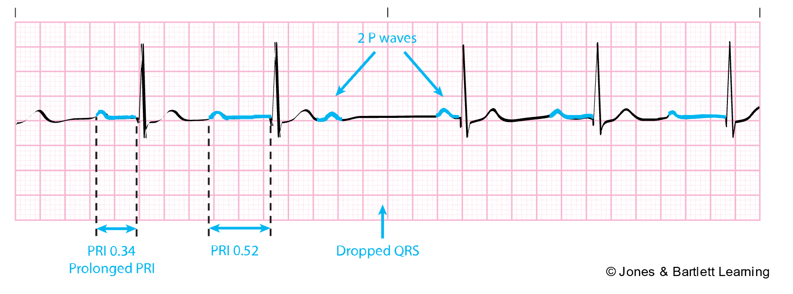 Introduction to Telemetry Monitoring for Arrhythmias Nursing CE Course ...