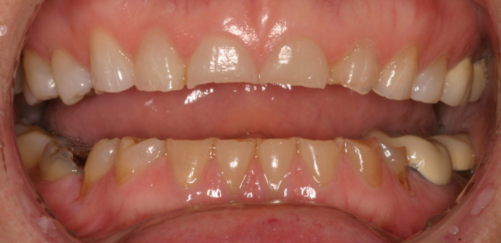 Stop grinding your teeth (results not pretty) | News, Sports, Jobs ...