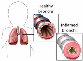 Elsevier – Patient Education │ Chronic Bronchitis, Pediatric