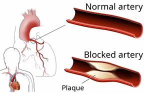 Elsevier – Patient Education │ Heart Attack