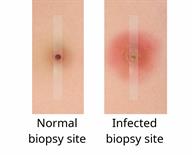 Skin Biopsy Care After