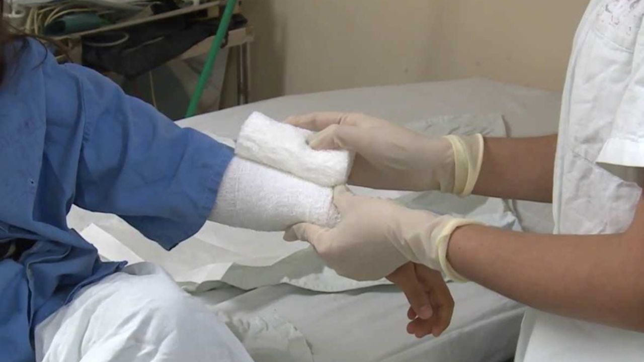 Hospital de niños quemados se encuentra en una ocupación del 40%