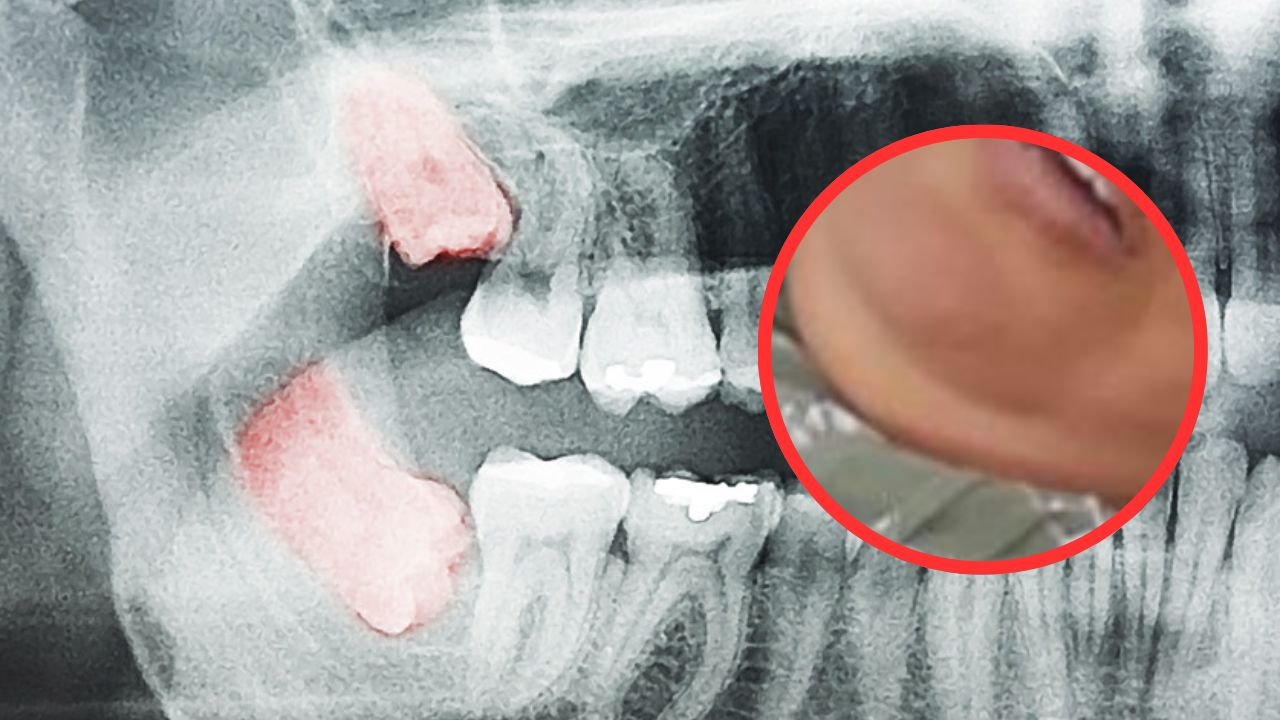 Hondureña, en estado de coma tras complicaciones por una muela; este es ...