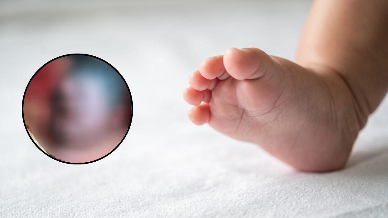 Nace bebé 'cíclope' por una malformación congénita, ¿dónde ocurrió ...