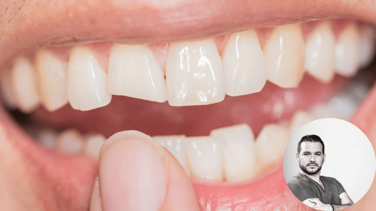 ¿A qué se deben las fracturas de dientes y por qué son más comunes en ...