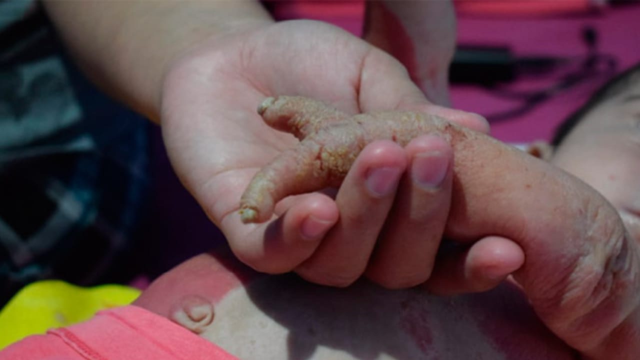 Conoce el caso de la bebé hondureña que nació con síndrome de 'mano en ...