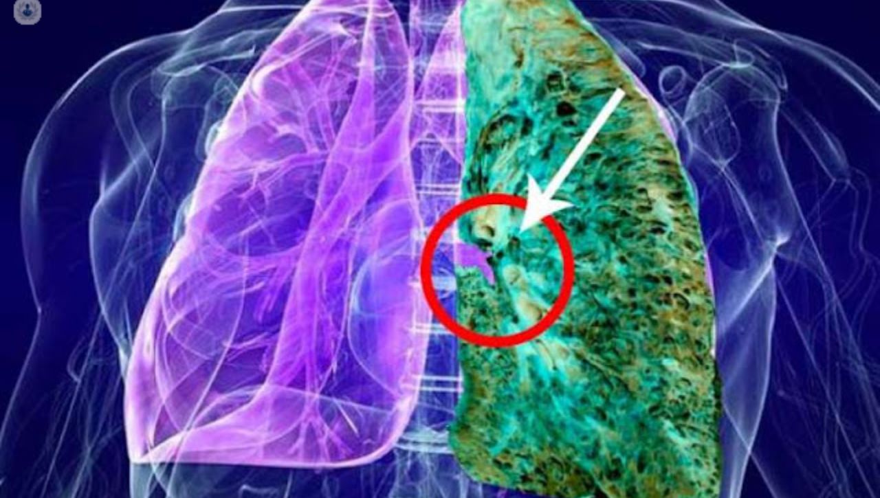 Fibrosis pulmonar, ¿qué es, cuáles son sus síntomas y cómo se debe tratar?