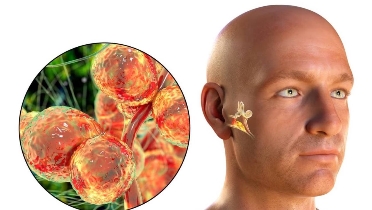¿Qué es el hongo Candida auris? La enfermedad que la CDC denomina como ...