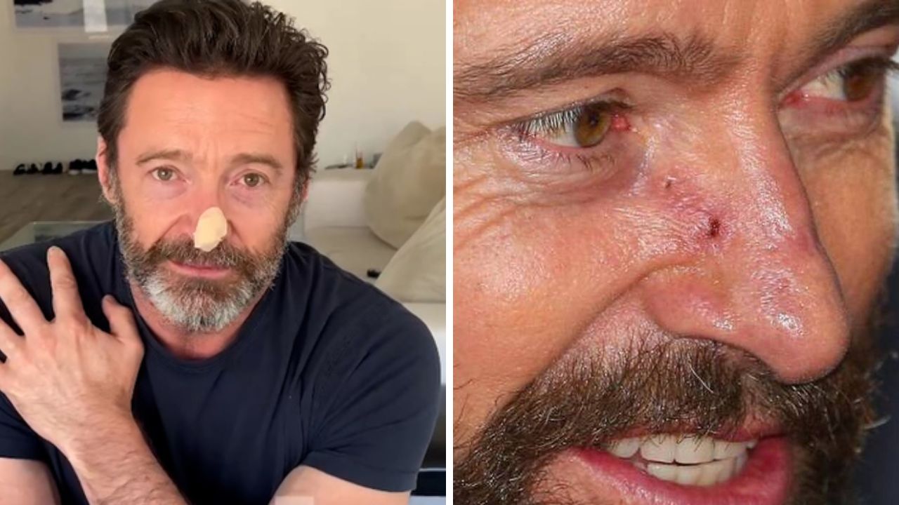 Hugh Jackman Cáncer De Piel El Actor Nuevamente Se Somete A Una Prueba