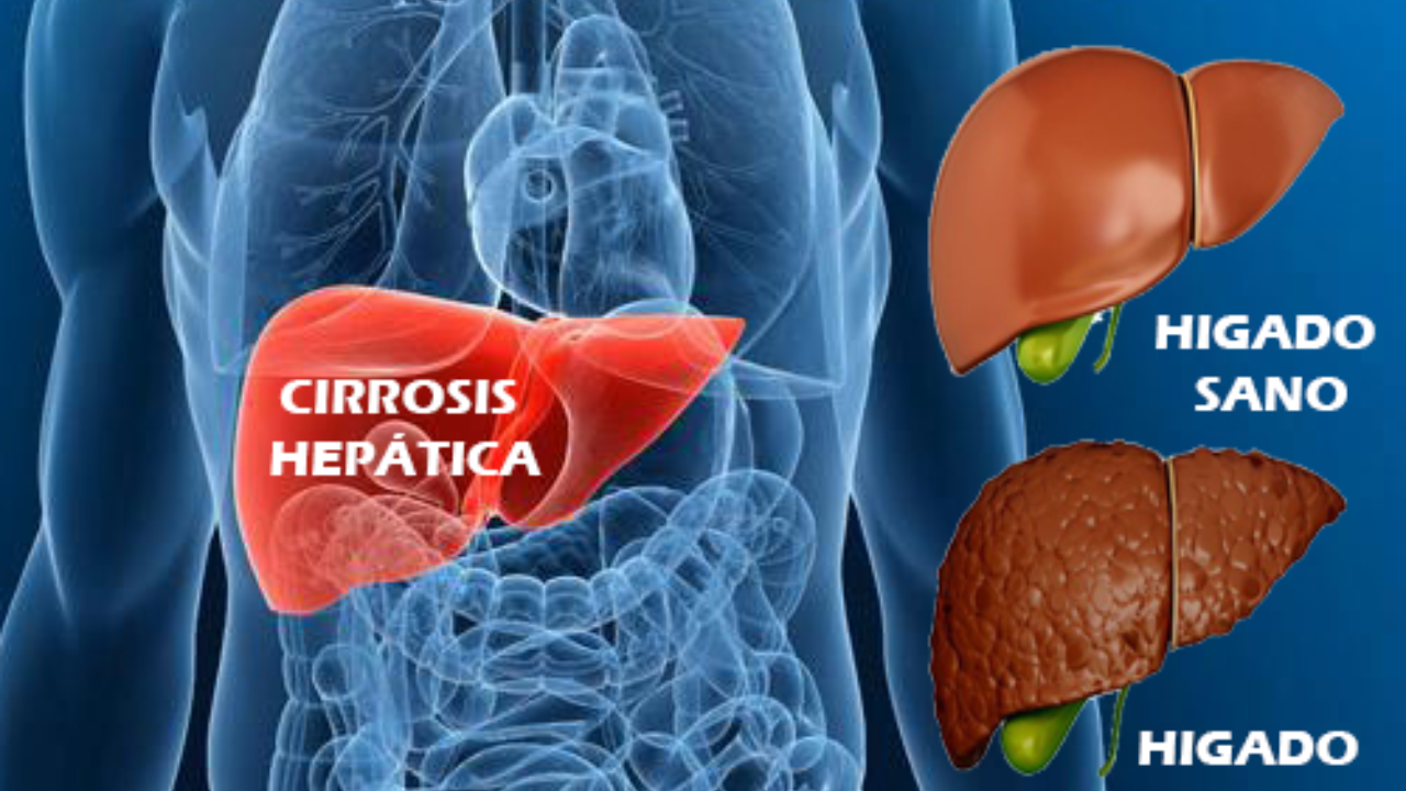 ¿Qué es la cirrosis hepática?, causas y síntomas de esta enfermedad