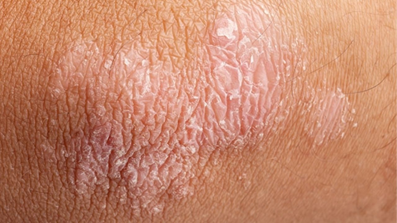 ¿Qué es la psoriasis en la piel? Fotos, síntomas y cómo tratar la ...