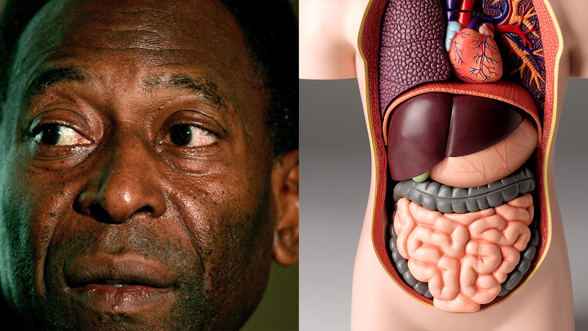 ¿Qué es falla multiorgánica, cuáles son las causas y síntomas de esta ...