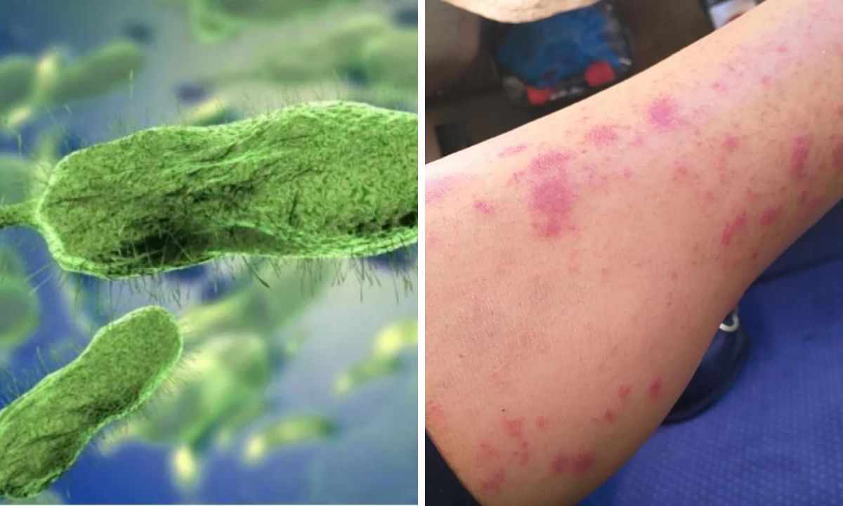 ¿Qué es la bacteria 'come carne' que ha cobrado la vida de 8 personas ...