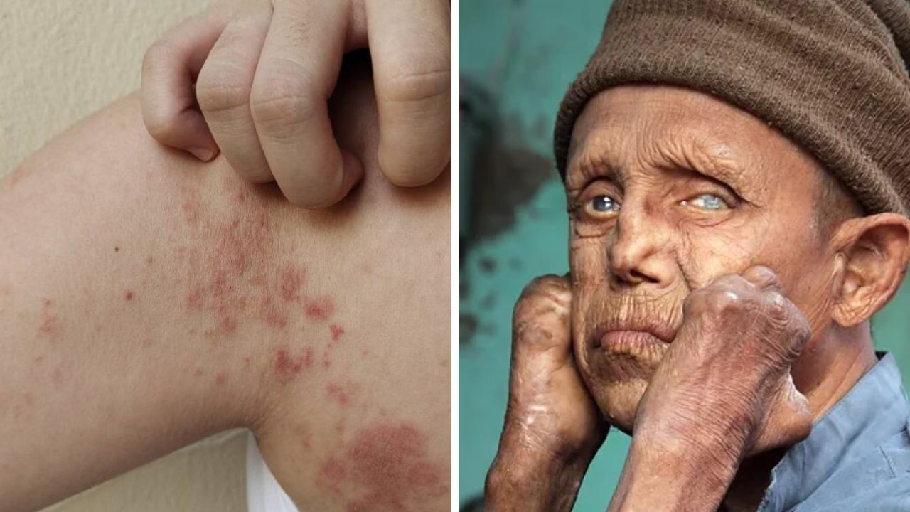 ¿Cómo se transmite la lepra? Síntomas, formas de tratar la enfermedad y casos en México