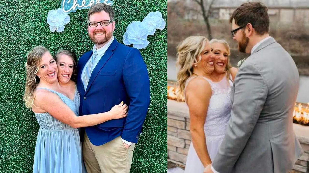 Una de las famosas gemelas siamesas encuentra el amor y contrae matrimonio