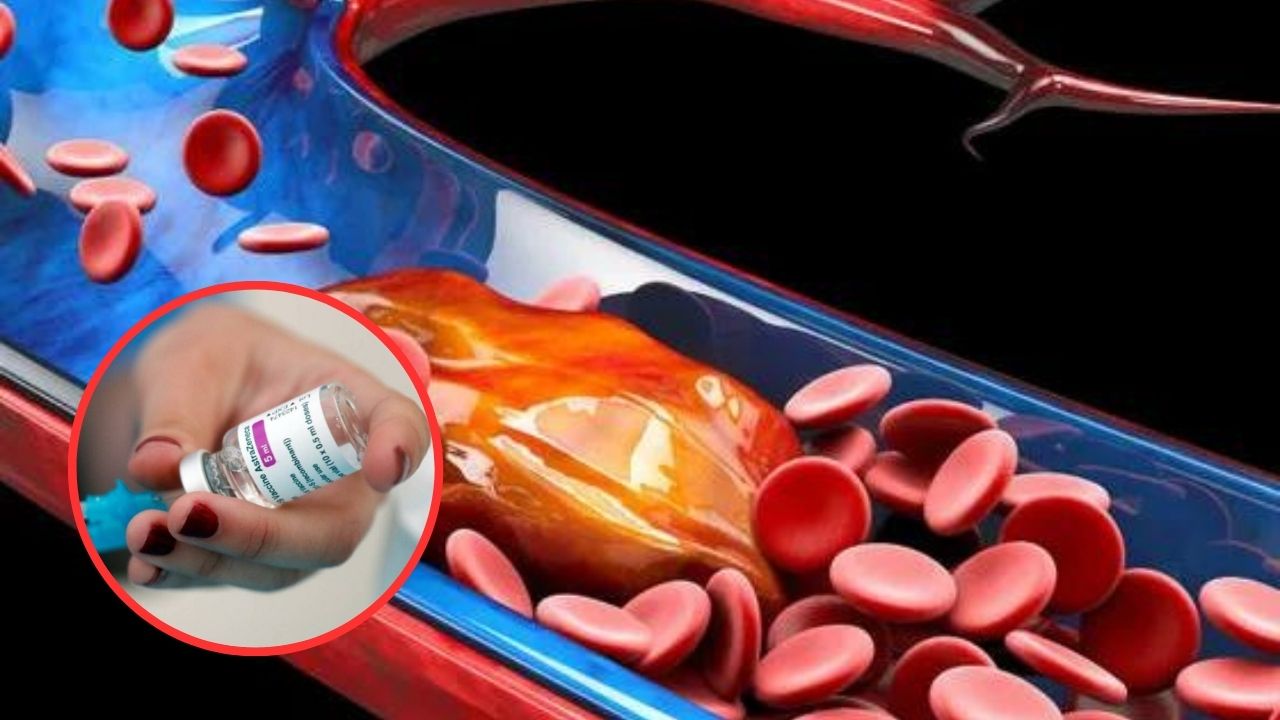 Estos son los síntomas de la trombosis, el efecto secundario de la ...