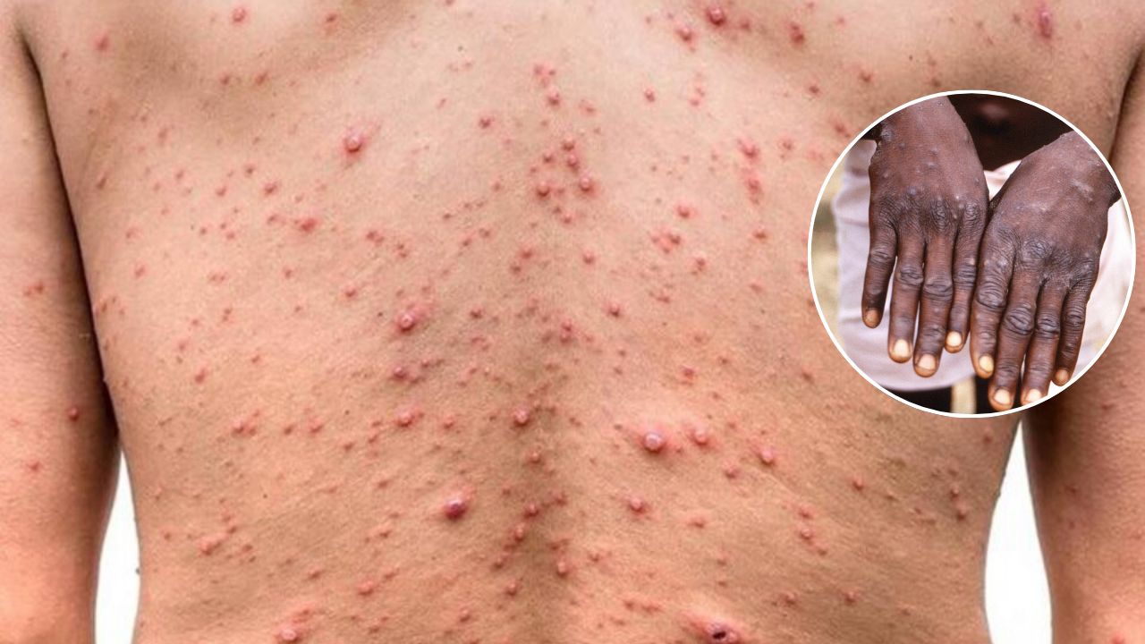 Fotos, síntomas y contagio de la viruela del mono