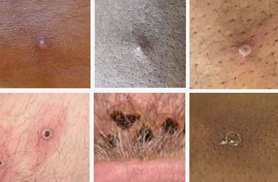 La viruela del mono fotos: ¿síntomas y cómo se contagia?