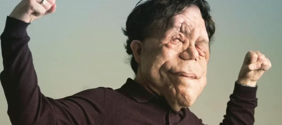 Adam Pearson antes y después: ¿Quién es y qué le pasó en el rostro?