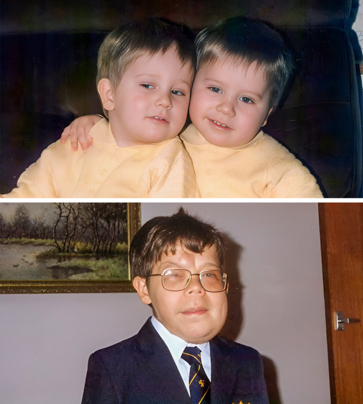 Adam Pearson antes y después: ¿Quién es y qué le pasó en el rostro?