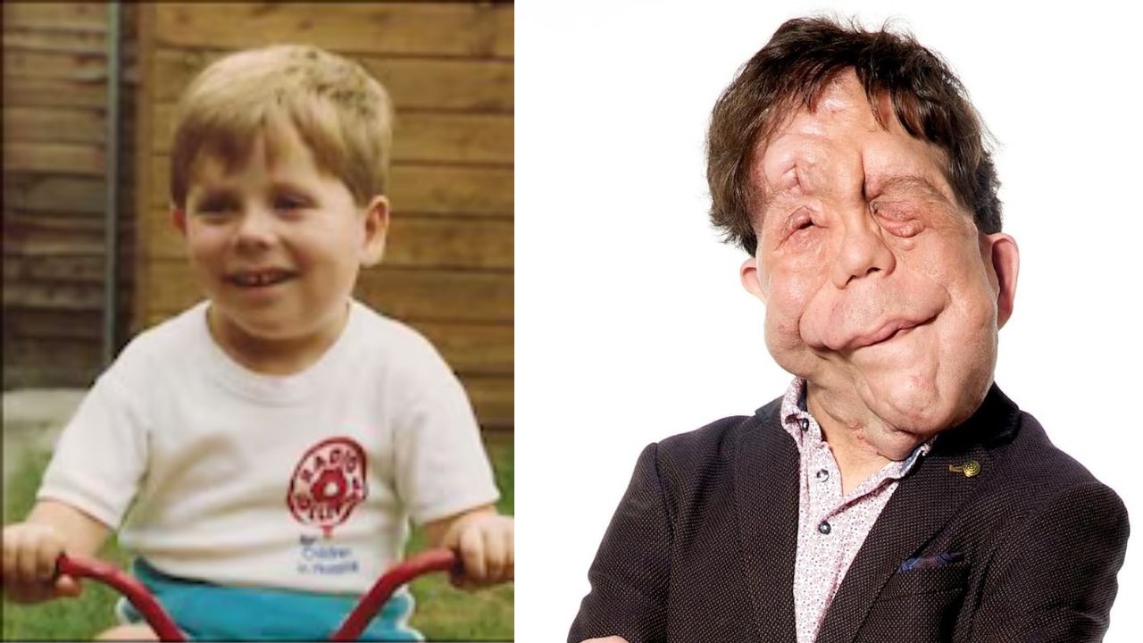 Adam Pearson antes y después: ¿Quién es y qué le pasó en el rostro?