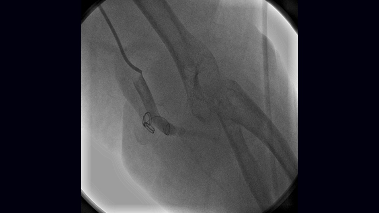 Arteriovenous Fistula for Hemodialysis Complicated by a Giant Venous ...