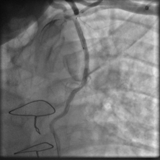 LIMA Stenting Through a Left Radial Approach After PCI of an LAD ...
