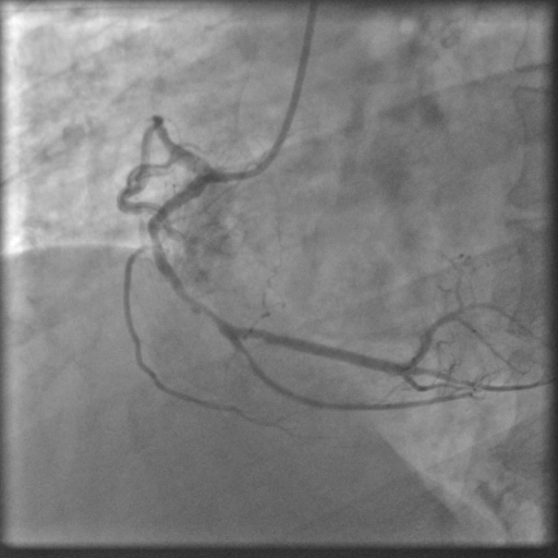LIMA Stenting Through a Left Radial Approach After PCI of an LAD ...