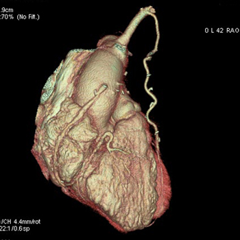 LIMA Stenting Through a Left Radial Approach After PCI of an LAD ...