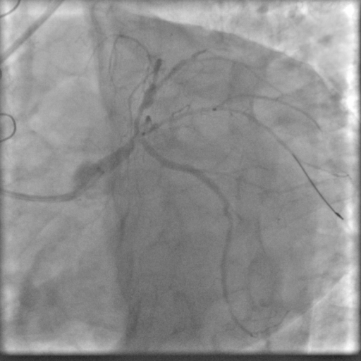 LIMA Stenting Through a Left Radial Approach After PCI of an LAD ...