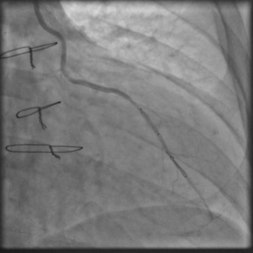 LIMA Stenting Through a Left Radial Approach After PCI of an LAD ...