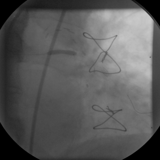 Distal Embolic Protection in SVG Intervention | tctmd.com