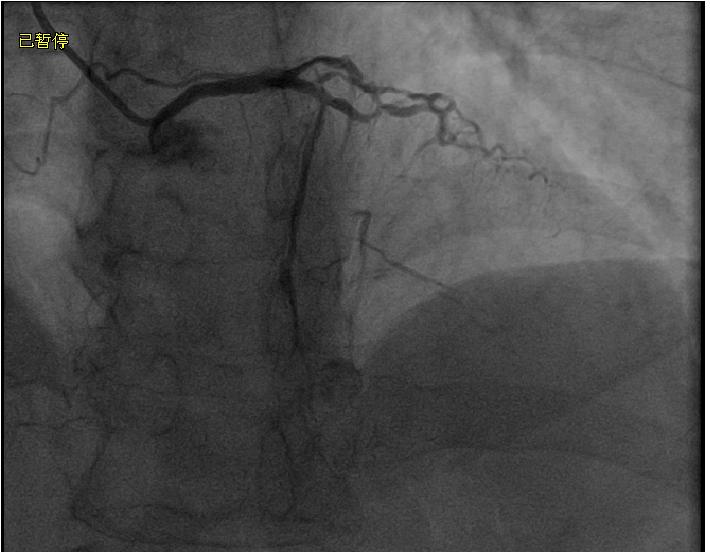 Using One Catheter Treats LAD CTO Through Septal Branch via Transradial ...