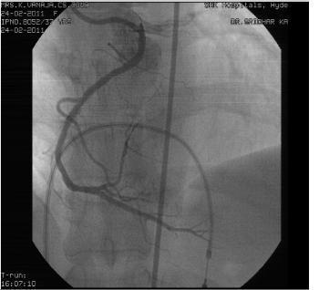 PCI of High Take-Off RCA from Left Coronary Sinus with Acute Inferior ...
