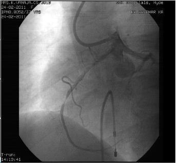 PCI of High Take-Off RCA from Left Coronary Sinus with Acute Inferior ...