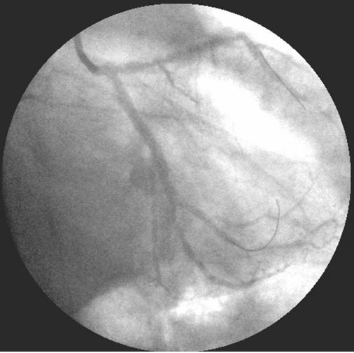 Distal LMCA Bifurcation Stenosis Treated with a Crush Technique | tctmd.com