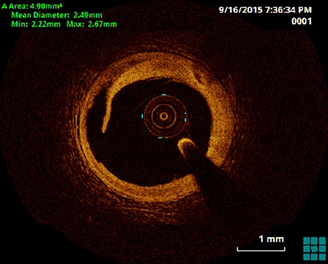 ILUMIEN III: OCT Imaging Matches IVUS but Fails to Beat Angiography for ...