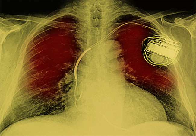 Conduction Problems Requiring Permanent Pacemakers Continue to Vex TAVR ...