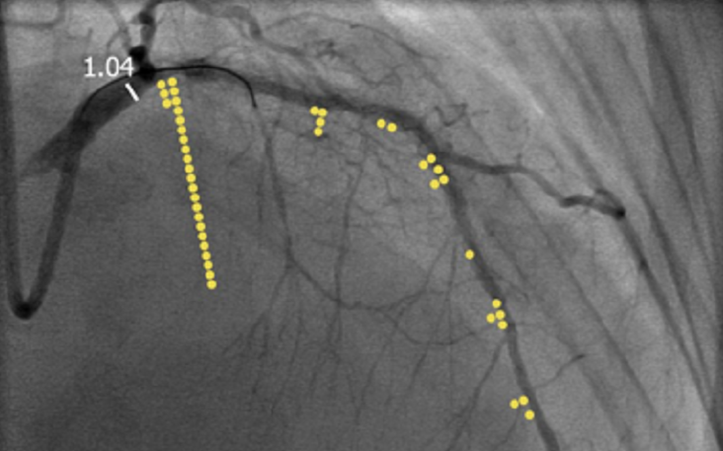 To Stent or Not to Stent? iFR vs FFR Late Breakers at ACC 2017 Seek to ...